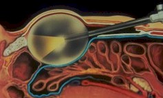 Hernia Repair in Long Branch | Inguinal, Ventral, Hiatal and Para ...