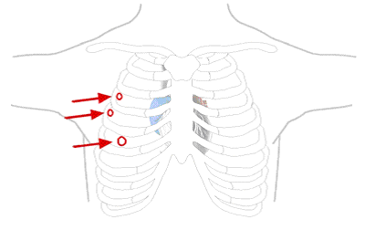 Mini-Maze Procedure | Heart and Vascular Care | New Jersey