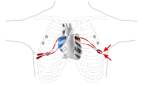 Minimally Invasive Atrial Fibrillation Treatment