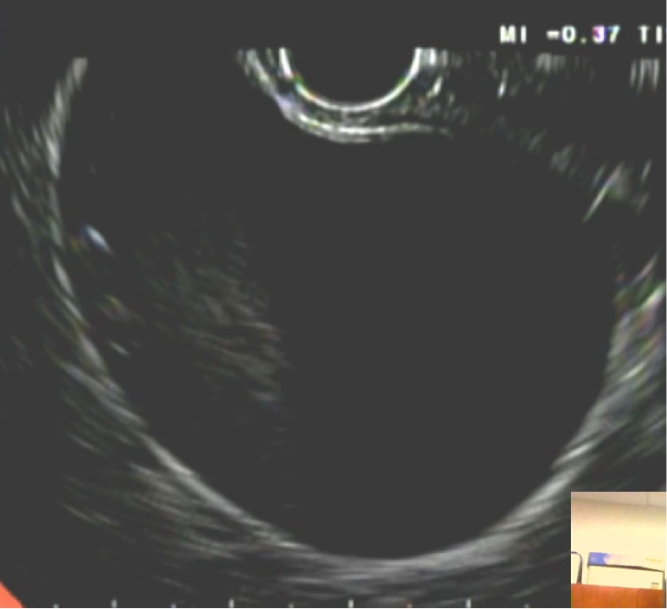 Therapeutic Endosonography | Advanced Endoscopy Services | RWJ ...