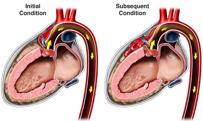 Aortic Dissection Treatment In New Jersey Heart And Vascular Care Aortic Dissection Treatment In New Jersey Heart And Vascular Care