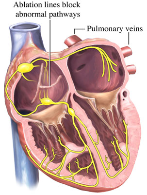 Mini-Maze Procedure | Heart and Vascular Care | New Jersey