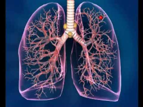 SuperDimension In Reach System | Cooperman Barnabas Medical Center Videos